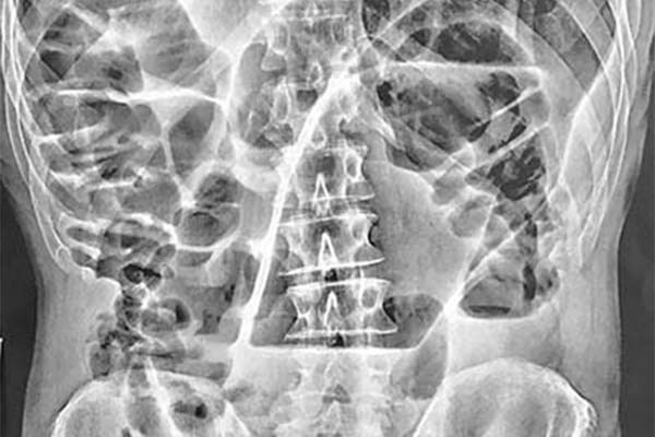 Chirurgie de l'occlusion intestinale - CCDO Bretagne (35, 44)